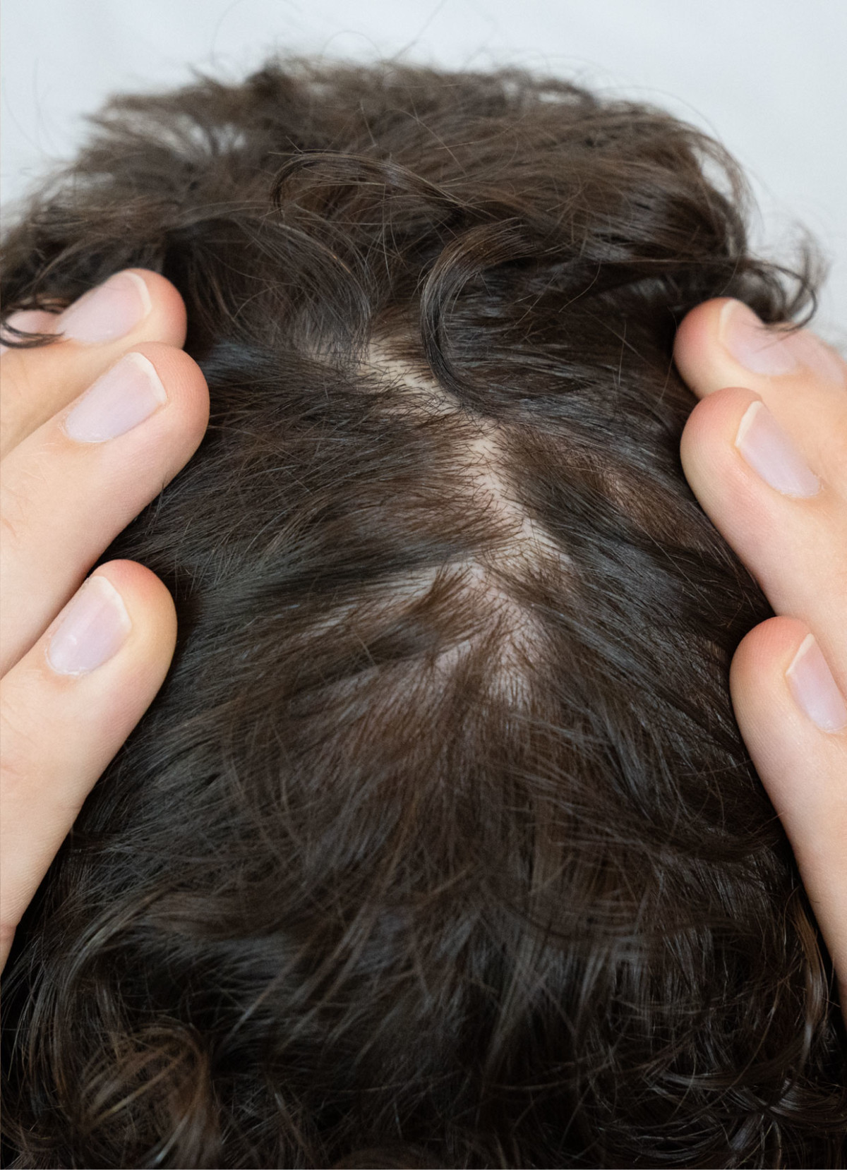 PRP - Vampire Lift - ono estetika - Aesthetic medicine and surgery